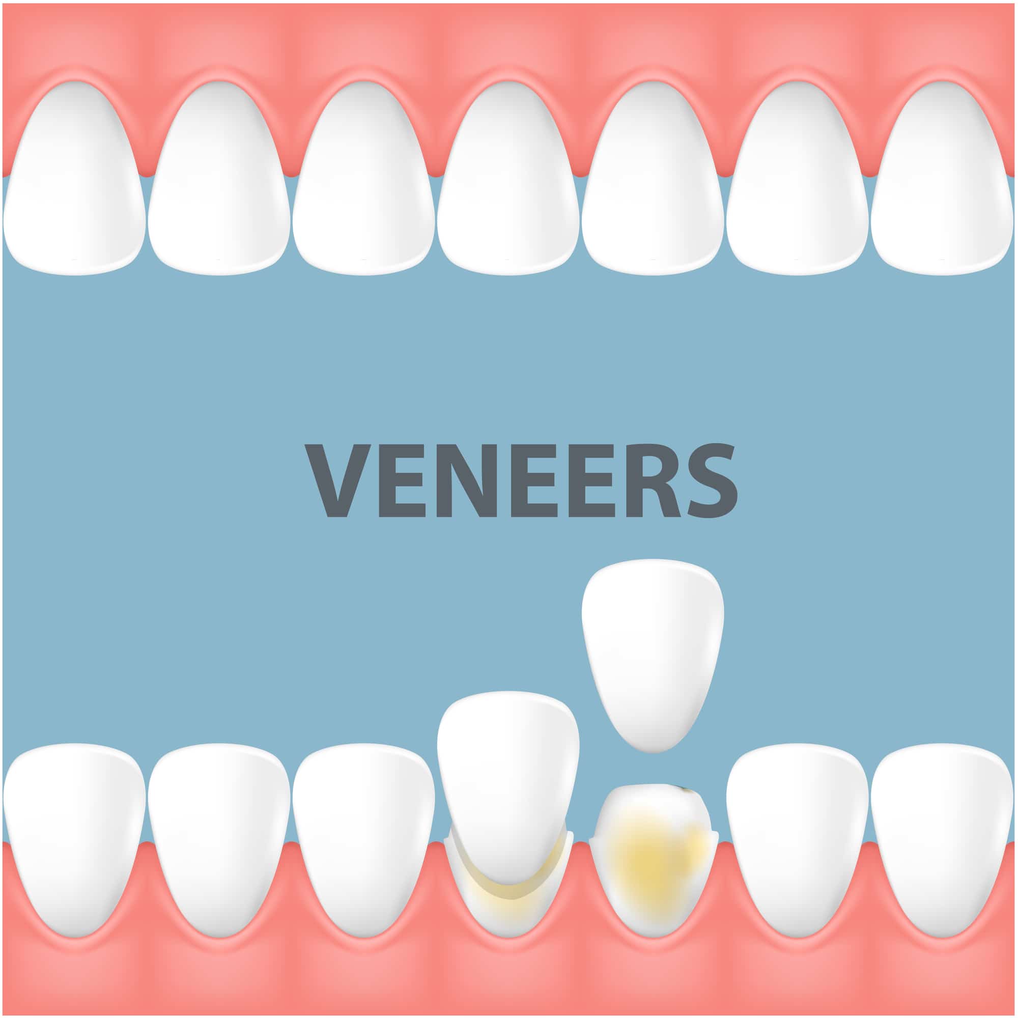 Veneers - Geelong Cosmetic Dental Clinic